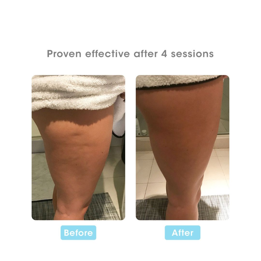°CRYO Slim Cellulite – CRYO UAE